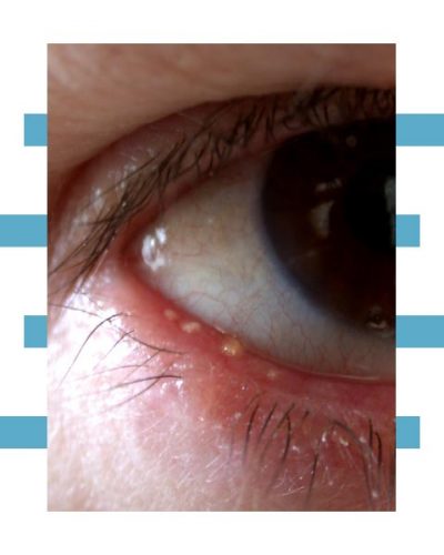 La blépharite - ACOS France